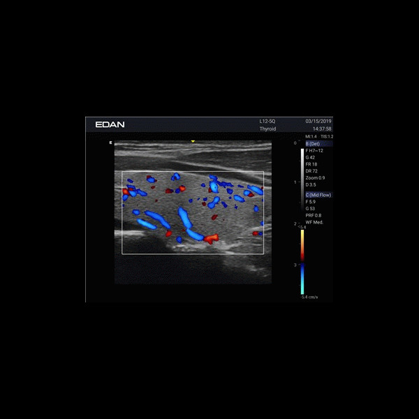 Edan Acclarix AX3 Compact Ultrasound System with Duel Sockets AX3 ...