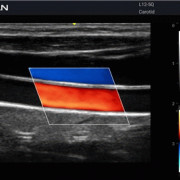 Edan Acclarix AX3 Compact Ultrasound System with Duel Sockets AX3 ...